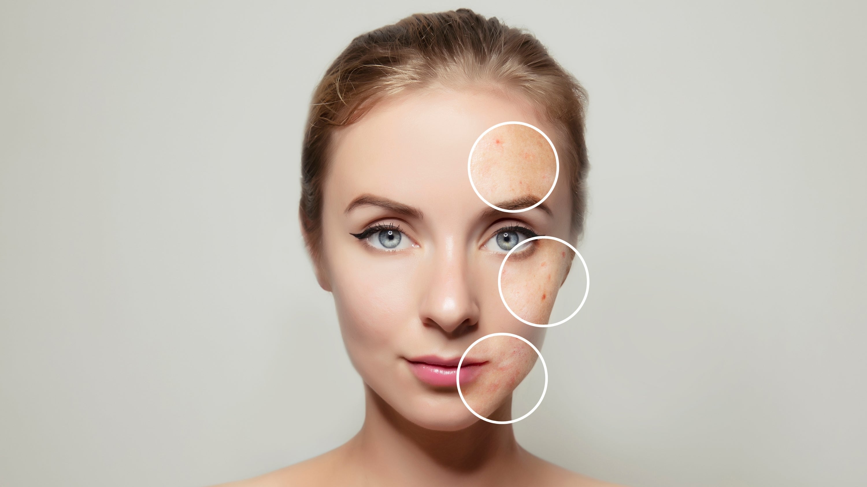 What You Need To Know About Hormonal Acne Ahaa® Skincare