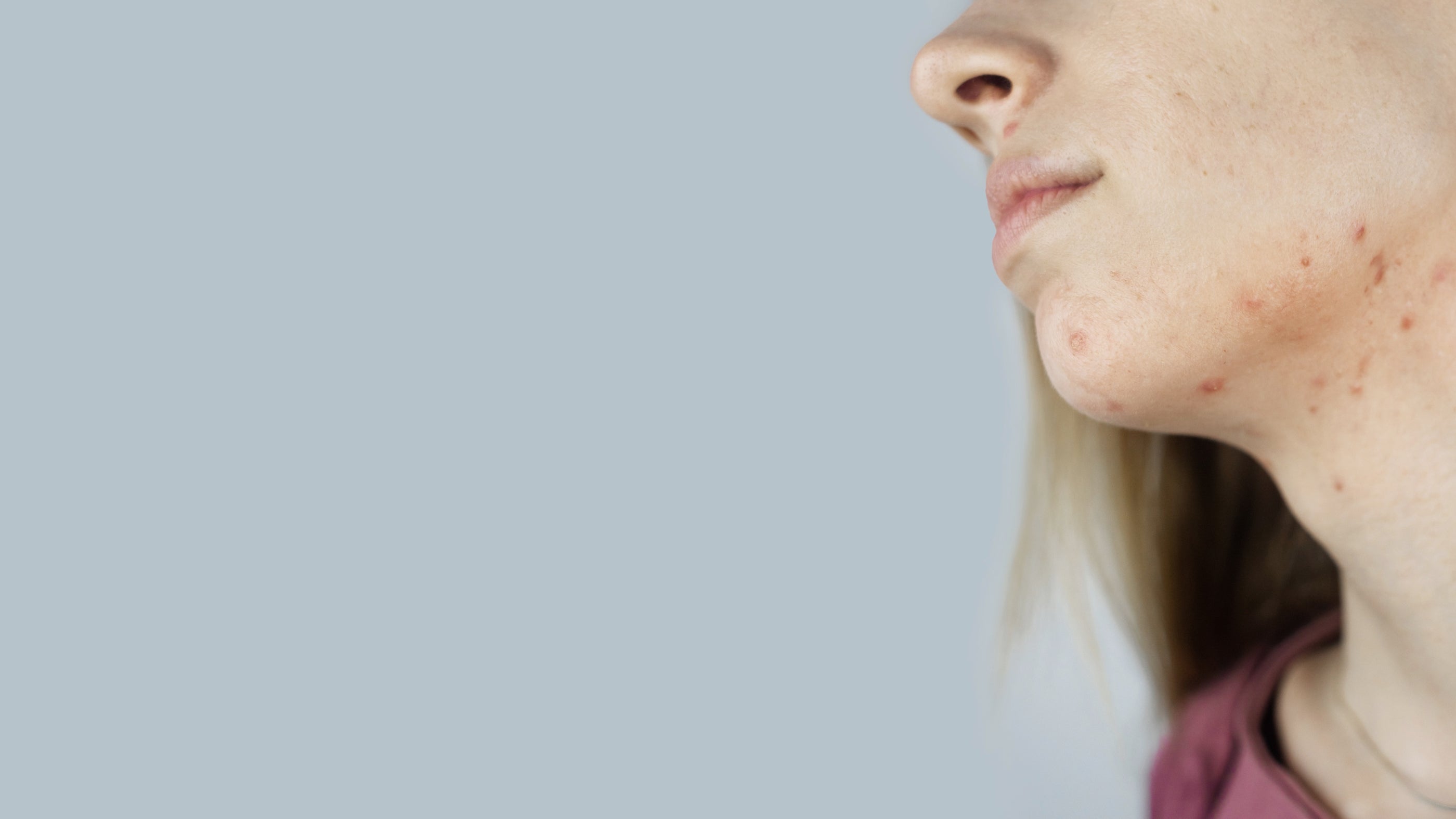 How to Heal Jaw Acne from the Inside-Out – Ahaa® Skincare.