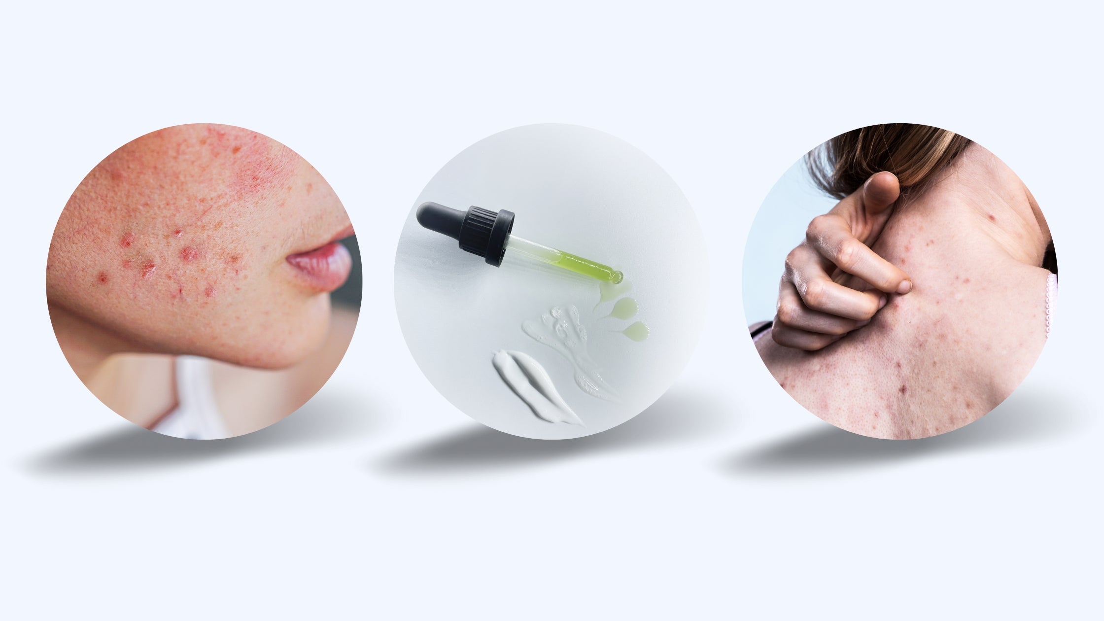 What is Fungal Acne? – Ahaa® Skincare.
