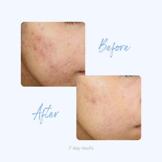 The Ultimate Acne-Fighting Vegan Products • Ahaa® Skincare – Ahaa ...